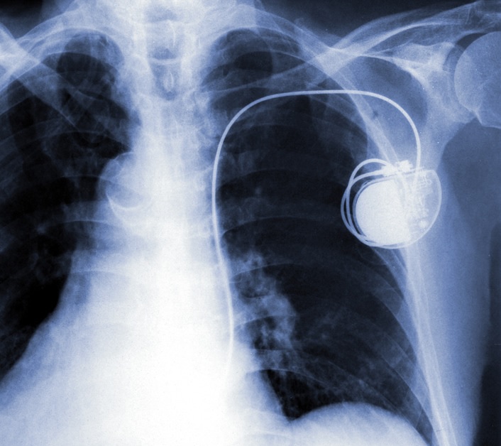 Pacemaker Monitoring Cardiovascular Medical Group Of Southern California